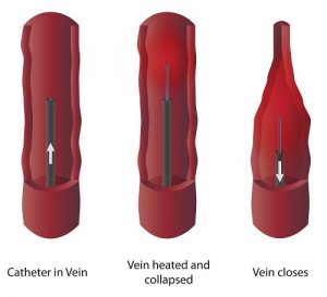 VenaSeal Sapheon Varicose Veins Closure System Montreal Care by Dr Ruz